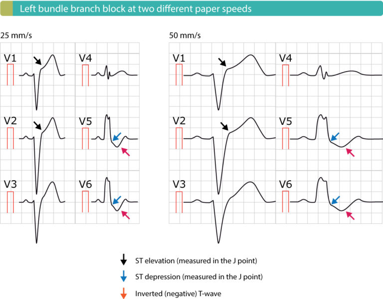 STEMI (ST Elevation Myocardial Infarction): diagnosis, criteria, ECG & management