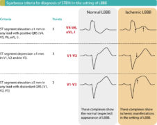 STEMI (ST Elevation Myocardial Infarction): diagnosis, criteria, ECG ...