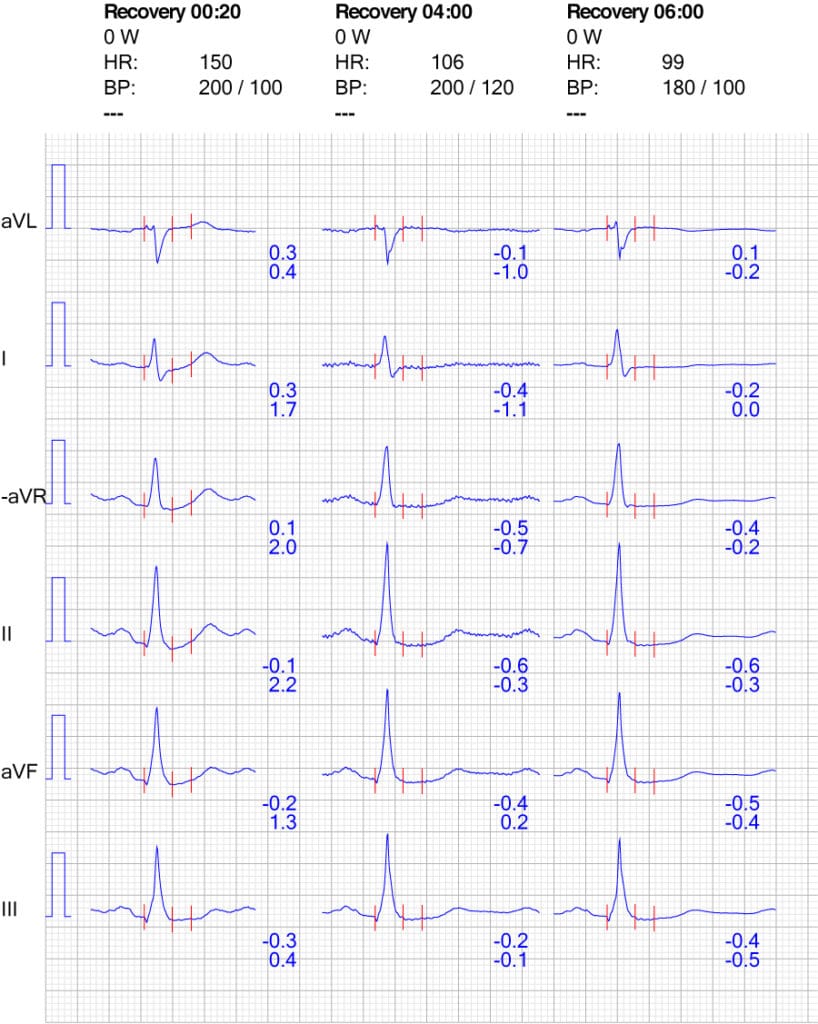 Evaluation of exercise stress test: ECG, symptoms, blood pressure ...