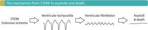 STEMI (ST Elevation Myocardial Infarction): diagnosis, criteria, ECG ...