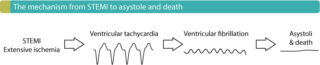 STEMI (ST Elevation Myocardial Infarction): diagnosis, criteria, ECG ...