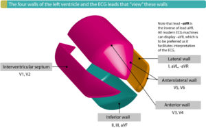 STEMI (ST Elevation Myocardial Infarction): diagnosis, criteria, ECG ...