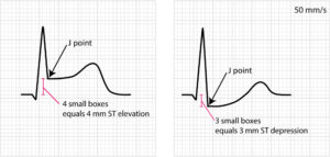 ECG in myocardial ischemia: ischemic changes in the ST segment & T-wave