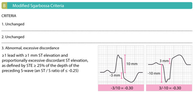 Left bundle branch block (LBBB) in acute myocardial infarction: the ...