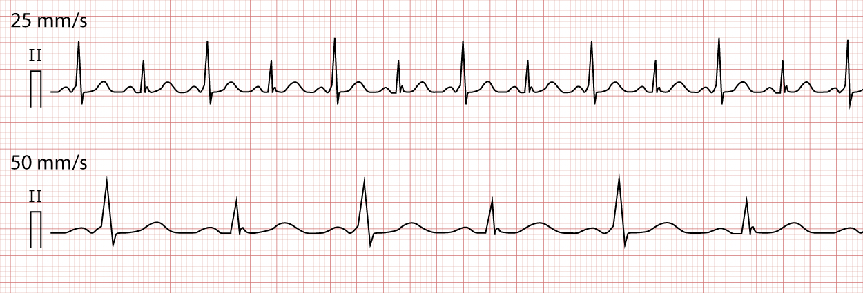 Pre-excitation, Atrioventricular Reentrant (Reentry) Tachycardia (AVRT ...
