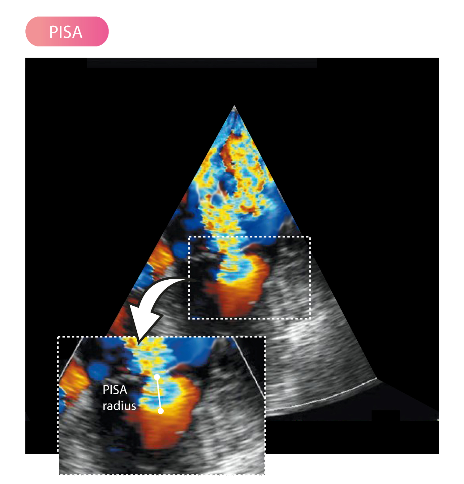 Proximal Isovelocity Surface Area (PISA)