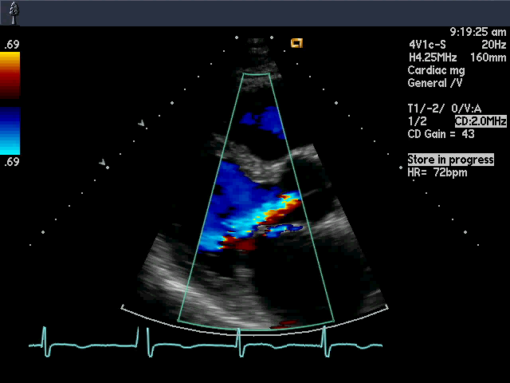Color Doppler
