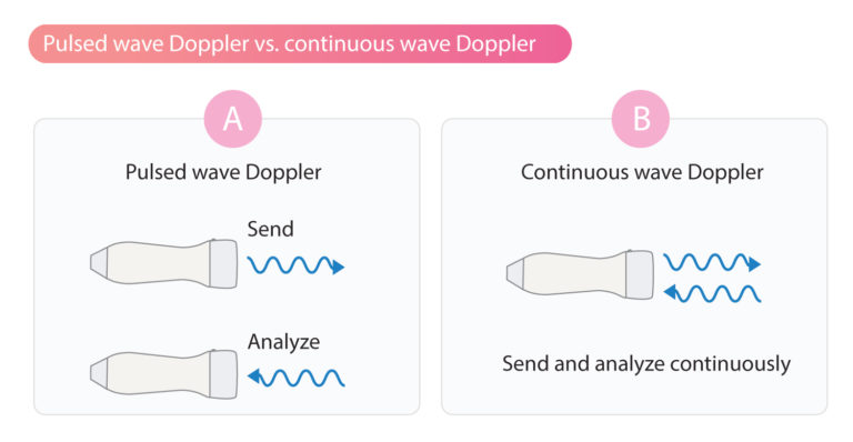 Continuous Wave Doppler (CW Doppler)
