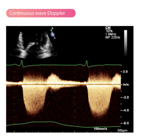 Continuous Wave Doppler (CW Doppler)