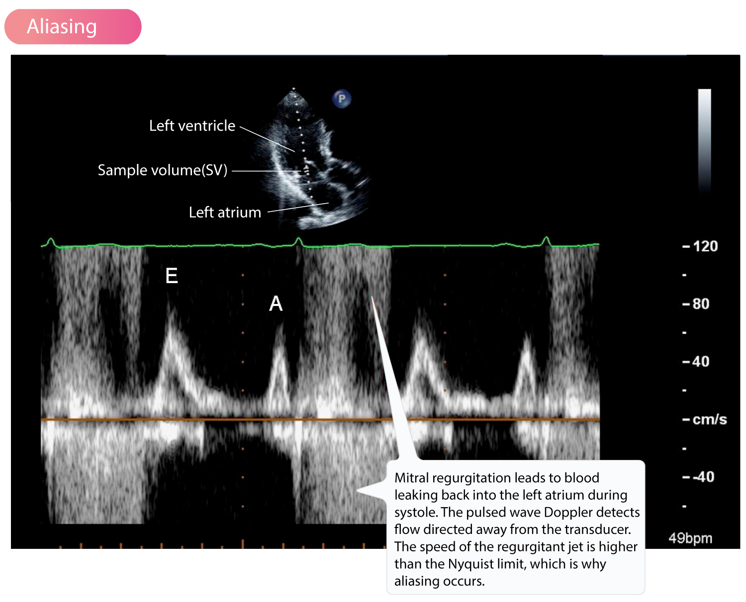 Pulsed Wave Doppler