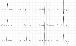 pediatric-ecg-hypertrophic-obstructive-cardiomyopathy – The Cardiovascular