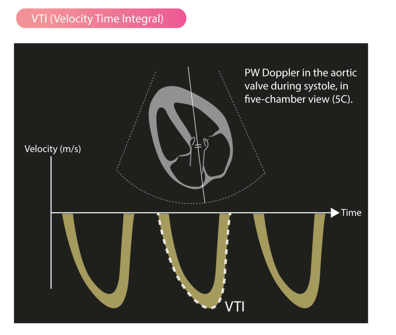 Stroke Volume, VTI (Velocity Time Integral) & Cardiac Output