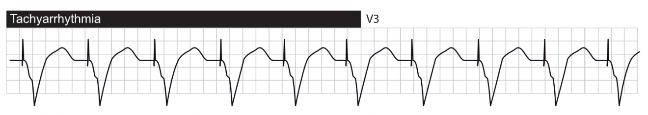 Assessment of Pacemaker Malfunction