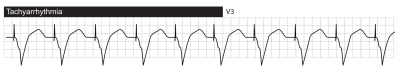 Assessment of Pacemaker Malfunction
