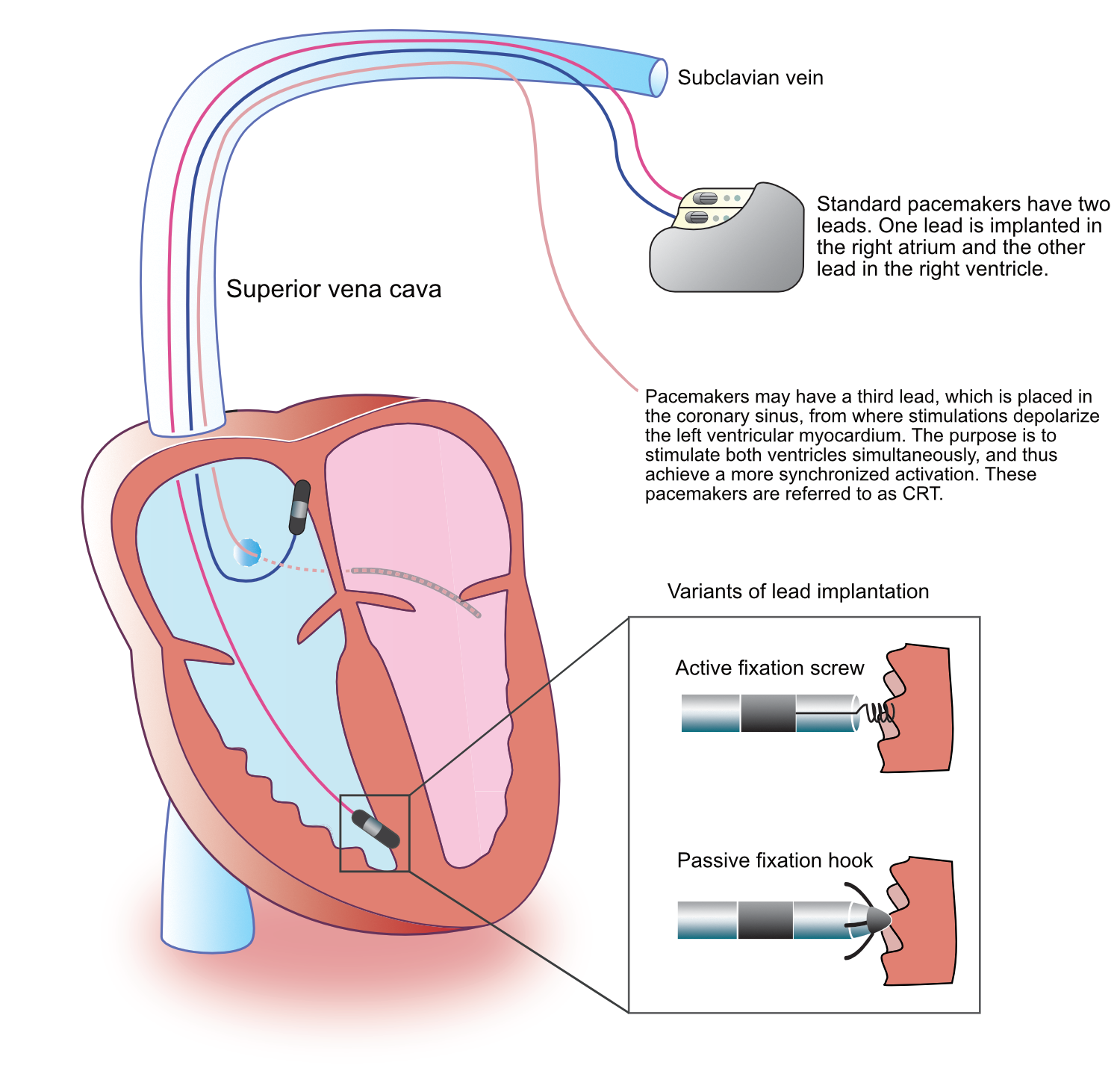 how-pacemaker-works-crt-icd-lead – The Cardiovascular
