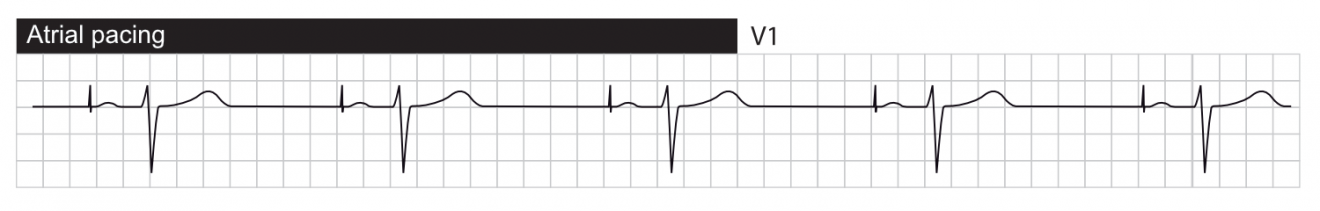 Interpretation of Pacemaker ECG