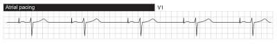 Interpretation of Pacemaker ECG
