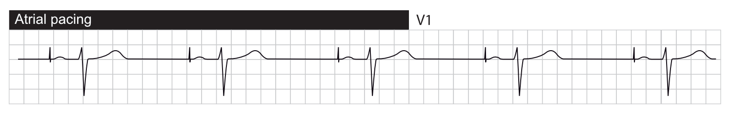 Interpretation of Pacemaker ECG