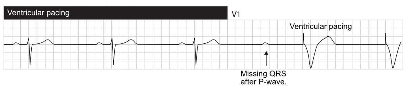 Interpretation of Pacemaker ECG