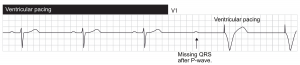 Interpretation of Pacemaker ECG