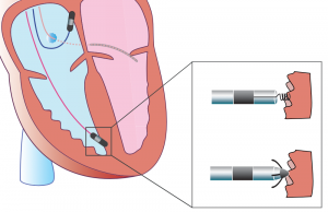 Pacemaker ECG Interpretation CRT ICD – The Cardiovascular