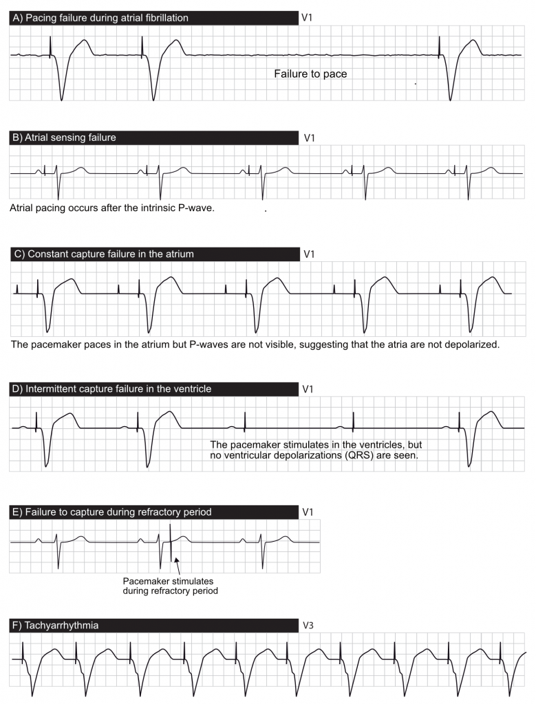pacemaker-ecg-examples-interpret-troubleshoot-failure – The Cardiovascular