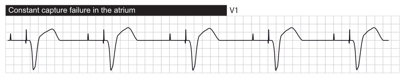 Assessment of Pacemaker Malfunction