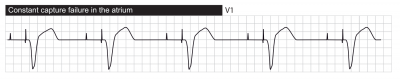 Assessment of Pacemaker Malfunction