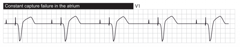 Assessment of Pacemaker Malfunction