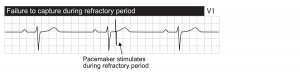 Assessment of Pacemaker Malfunction