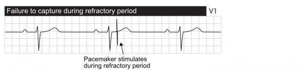 Assessment of Pacemaker Malfunction