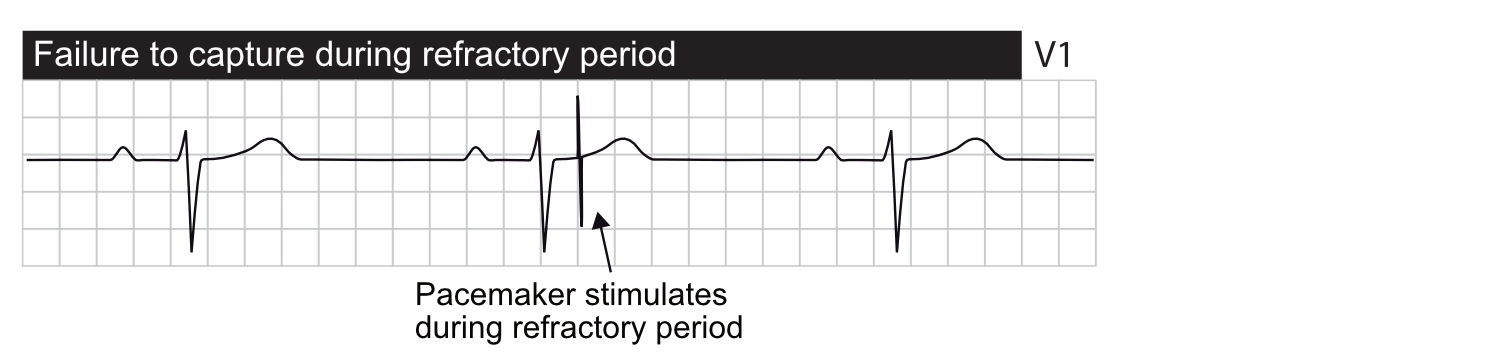 Assessment of Pacemaker Malfunction
