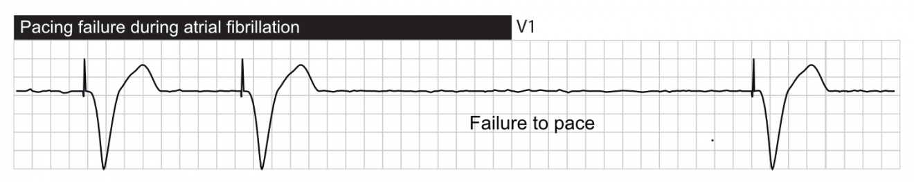 Assessment of Pacemaker Malfunction