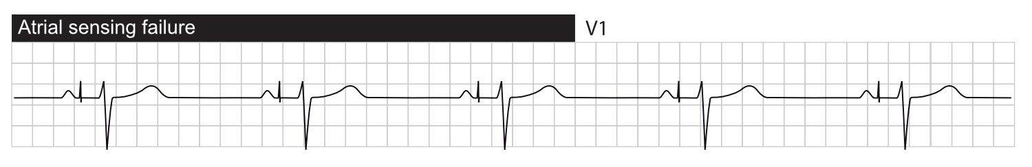 Assessment of Pacemaker Malfunction