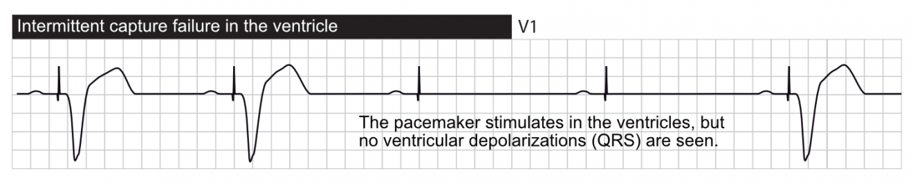 Assessment of Pacemaker Malfunction