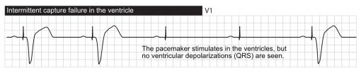 Assessment of Pacemaker Malfunction