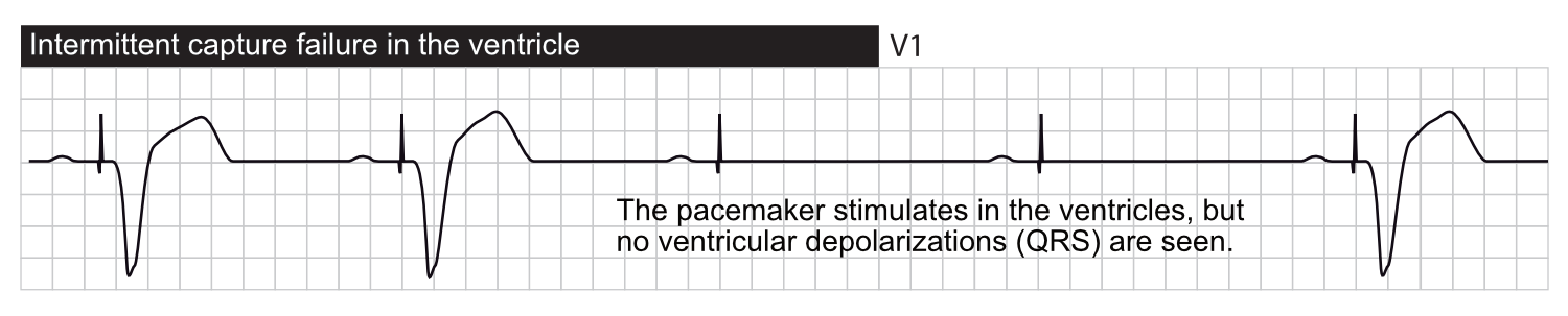 Assessment of Pacemaker Malfunction