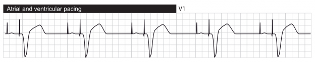 Interpretation of Pacemaker ECG