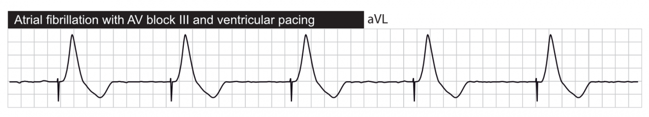 Interpretation of Pacemaker ECG