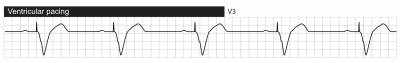 Interpretation of Pacemaker ECG