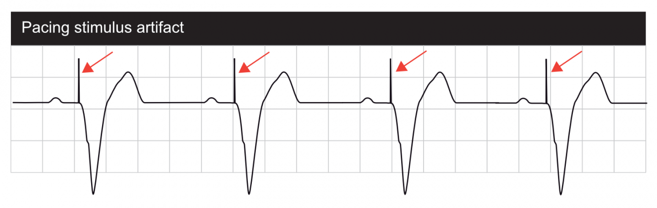 Components and construction of a pacemaker