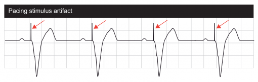 Components and construction of a pacemaker