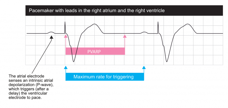 Basic cardiac pacing, pacemaker functions and settings