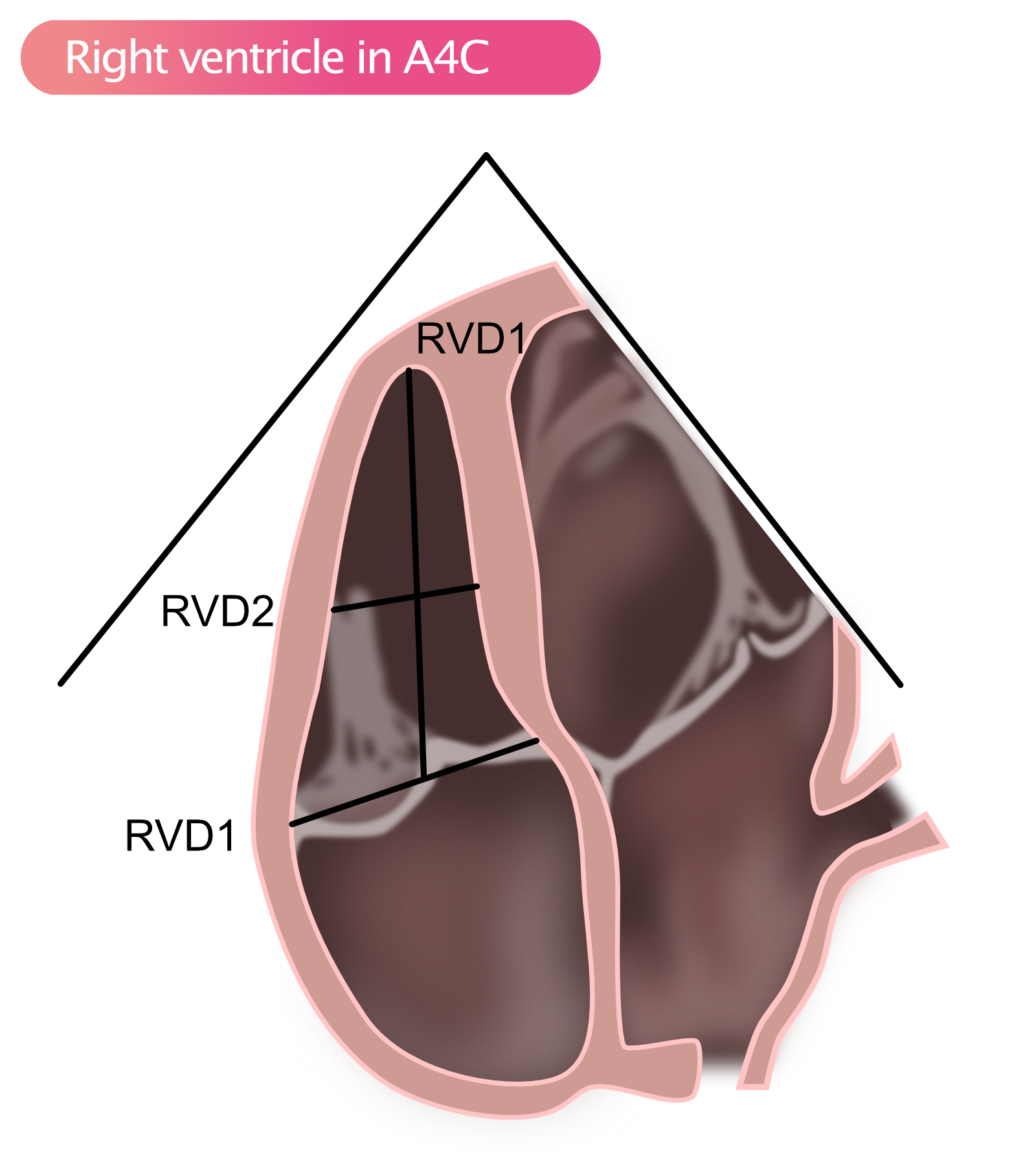 right-ventricle-apical-four-chamber-view-diameter-measurements – The ...