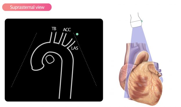 suprasternal-notch-view-echocardiography-window-image – The Cardiovascular