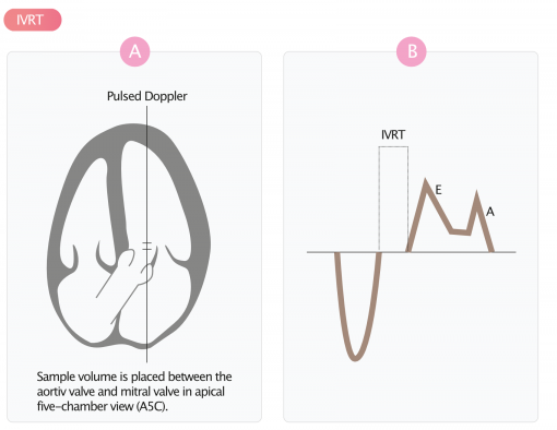 Assessment of diastolic function by echocardiography