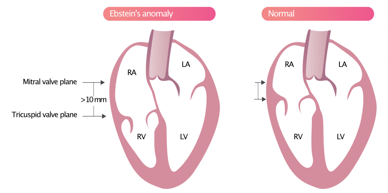 tricuspid-regurgitation-echocardiography-ebsteins-anomaly – The ...