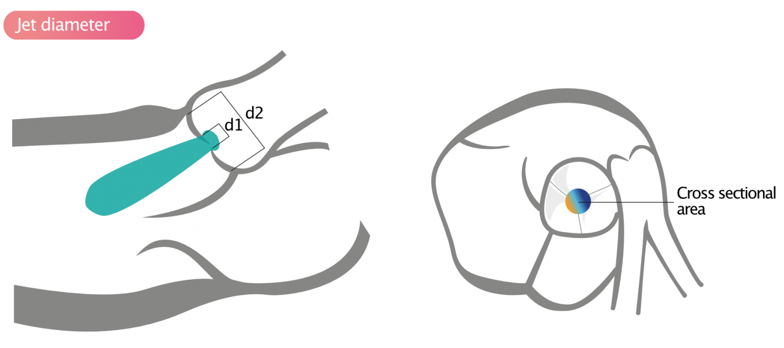 aortic-regurgitation-criteria-echocardiography-valve-jet-diameter – The ...