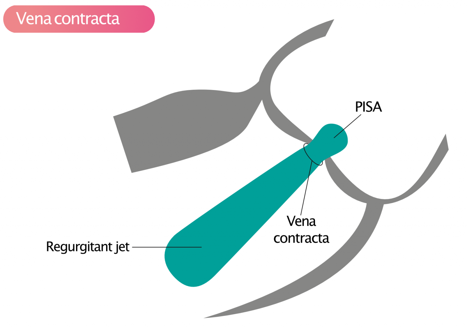 aortic-regurgitation-echocardiography-criteria-vena-contracta ...