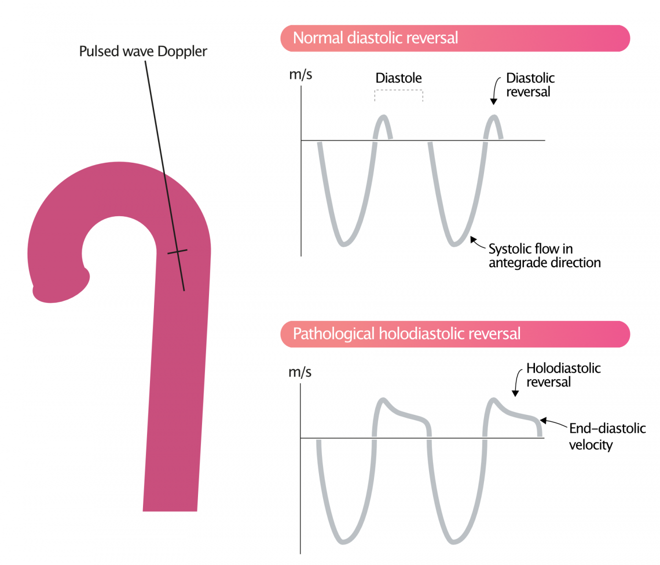 aortic-regurgitation-echocardiography-doppler-holodiastolic-flow ...